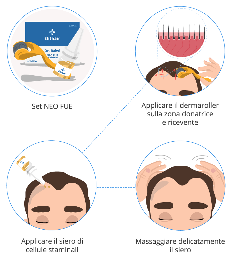 Trattamento NEO FUE®: un metodo rivoluzionario | Elithair